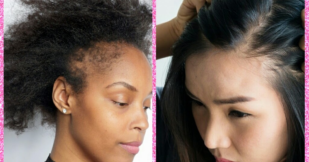 HAIR LOSS: causes and treatment for all hair types...