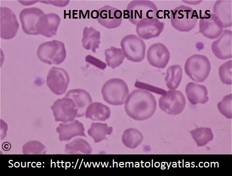 Lab Atlas: Hemoglobin C Crystals