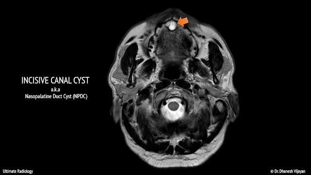 Ultimate Radiology : Incisive Canal Cyst (Nasopalatine Duct Cyst, NPDC)
