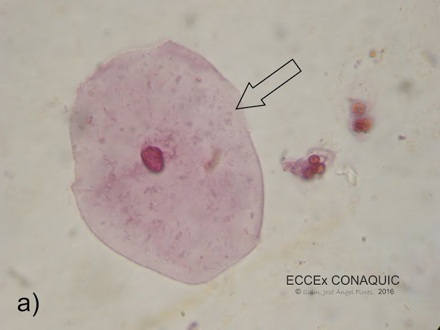 Caso UR-julio-16 (Enfoque: uroepitelio)