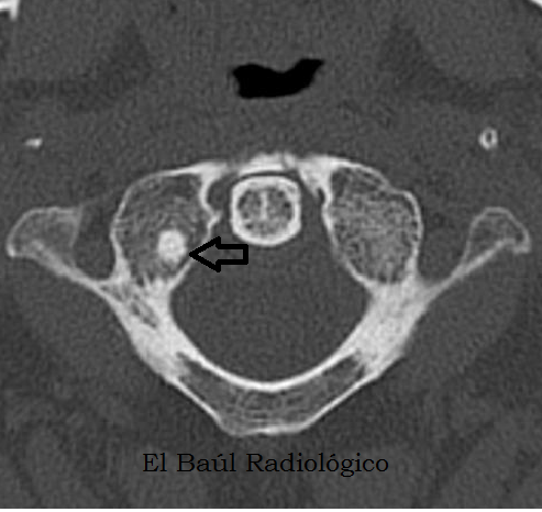 El Baúl Radiológico: ENOSTOSIS: ISLOTE ÓSEO (Bone Island: CT and MRI ...