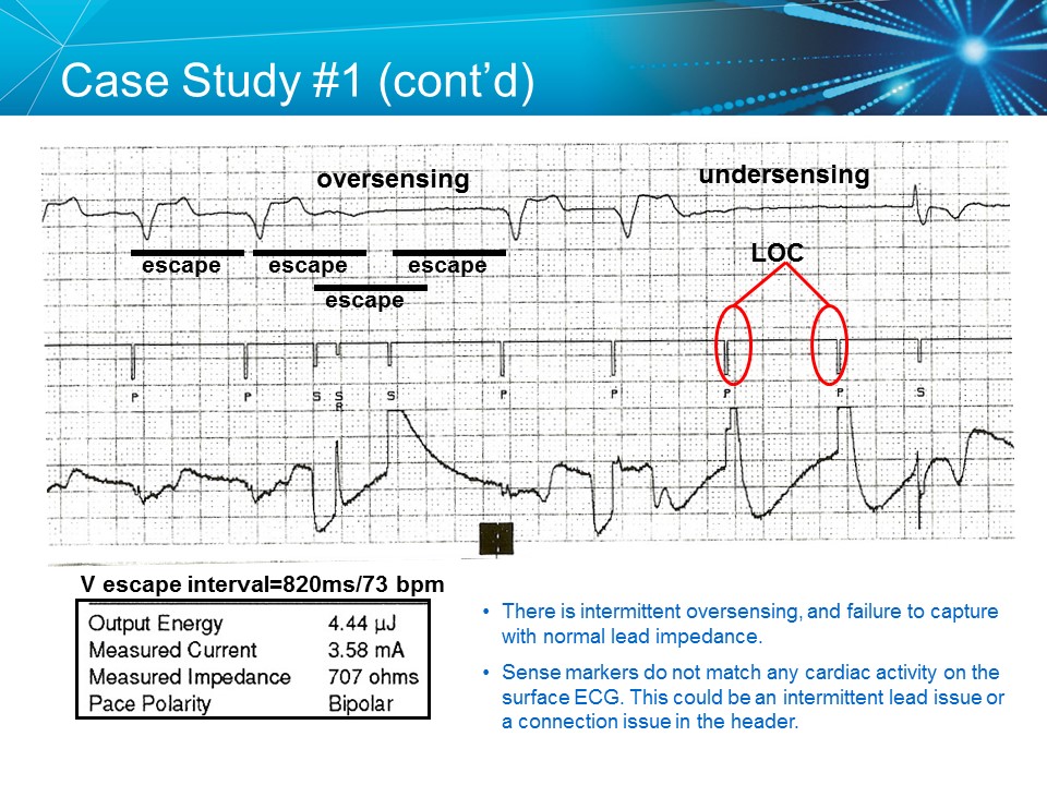 CVT Mohd Farid: Pacemaker Follow Up Part II-Medtronic Academy