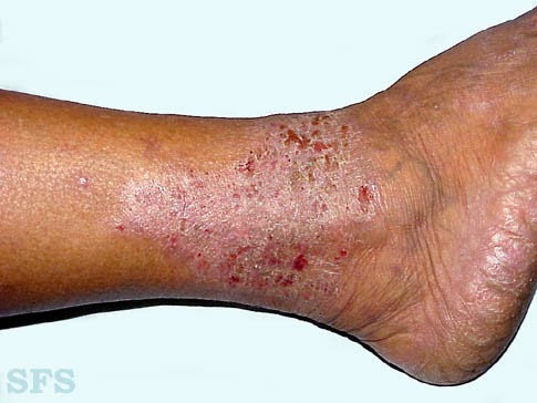 Eksim (dermatitis) | Info Penyakit Kulit