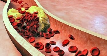 How Bacteria can Clog up our Arteries ? Its not your Diet