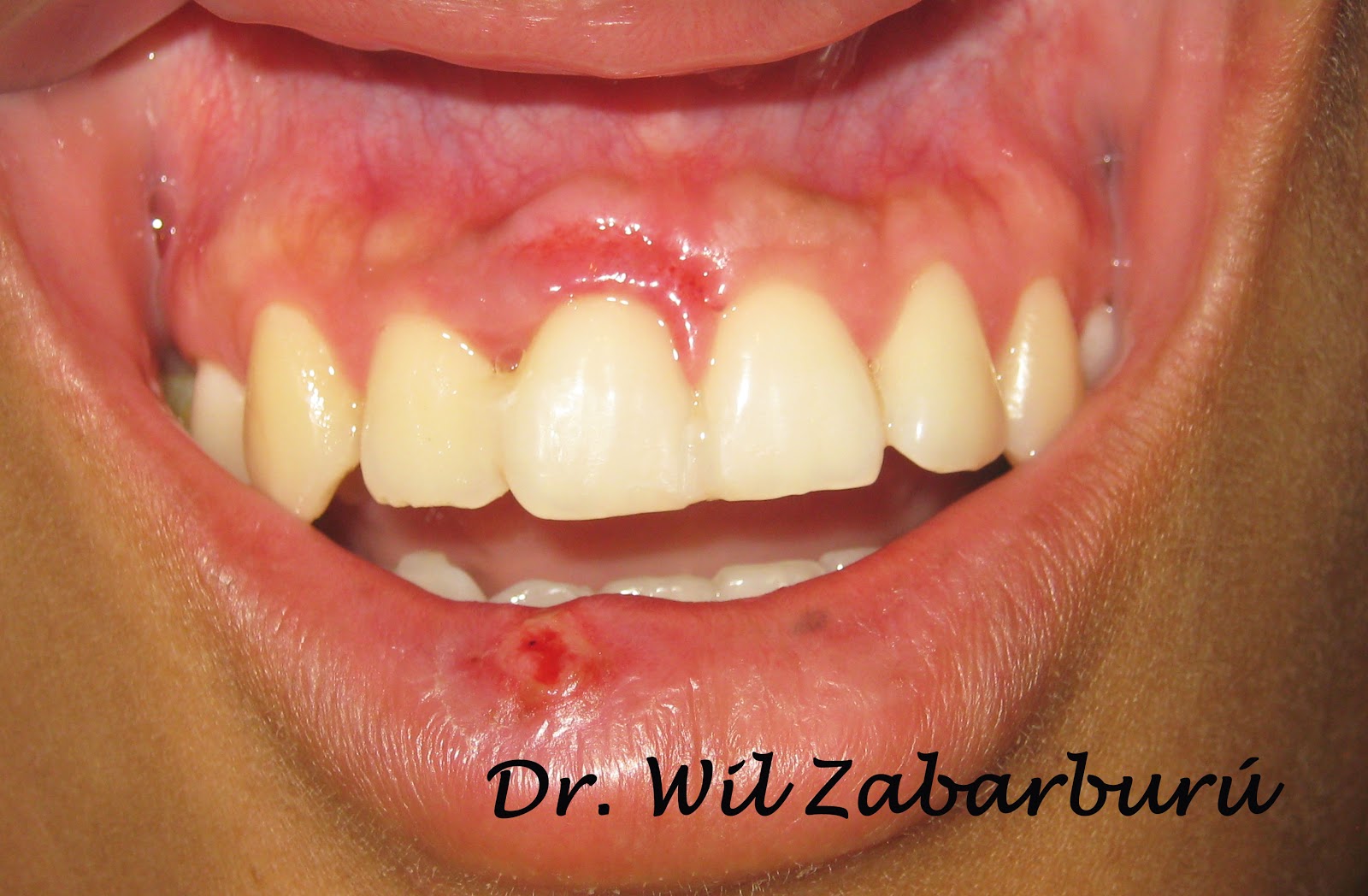 CLINICA DENTAL ASISTENCIAL: LACERACIÓN LABIAL Y TRAUMA DENTARIO