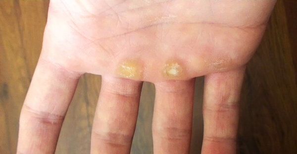 Callosidades, los molestos callos - Belleza, Salud