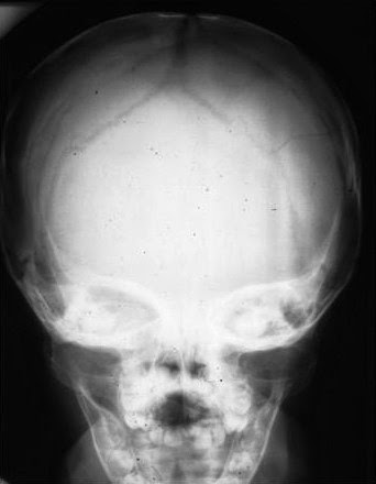 TEC y rasgos de fractura de cráneo en radiografía. | ESPE 202 - 2014