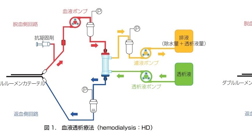 松下 ER ランチ・カンファレンス: HD - HF - HDF - CHD - CHF - CHDF