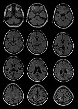 Dr Balaji Anvekar FRCR: Systemic lupus erythematosus (SLE) MRI Brain