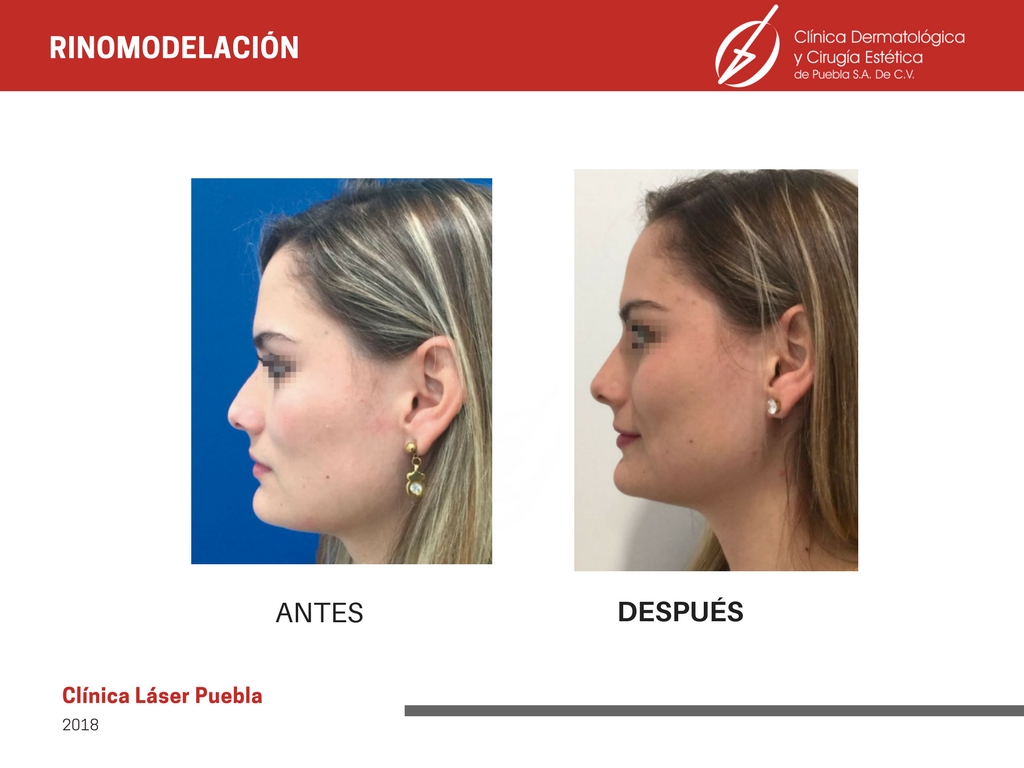 Conoce la Rinomodelación Tratamiento Sin Cirugía para Mejorar el Perfil de la Nariz, Levantar la ...