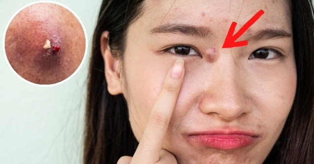 Kystes épidermoïdes: Ces grosses bosses peuvent être confondues avec ...