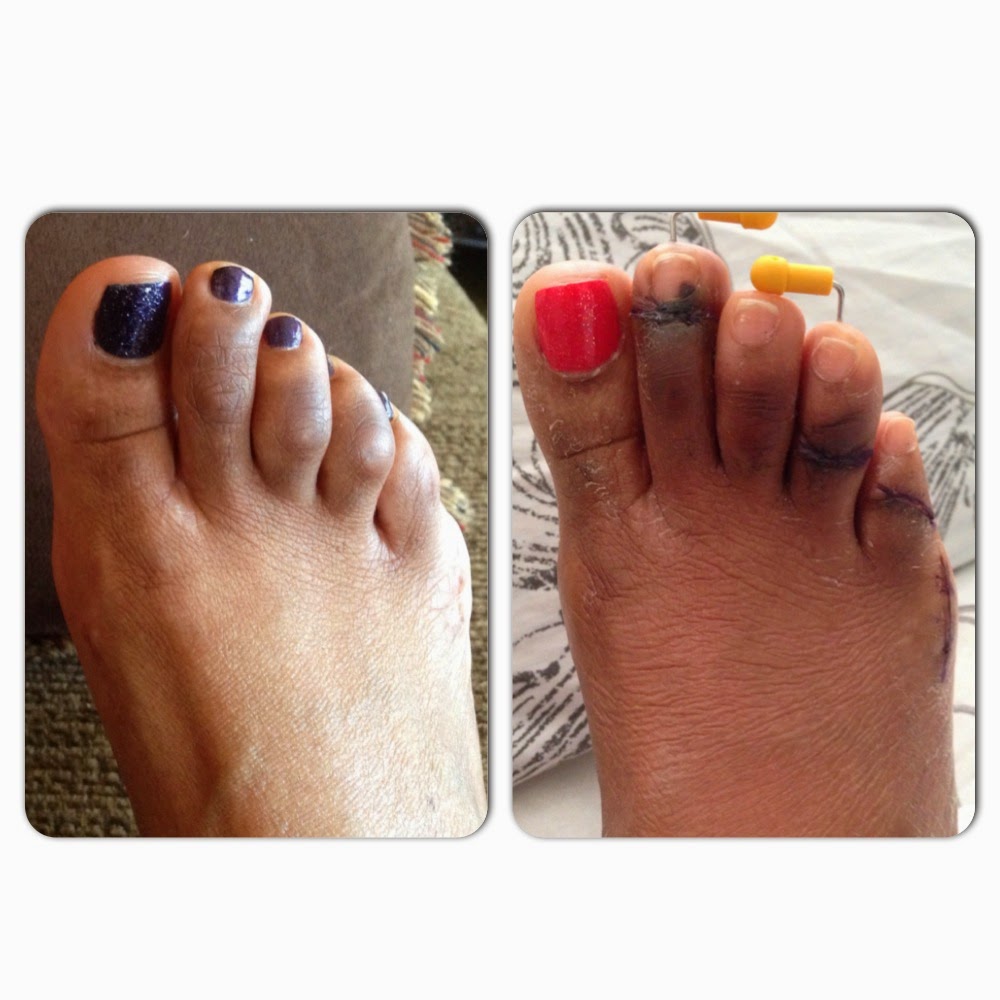 Cause And Treating Hammertoes - Marybelle Rafla