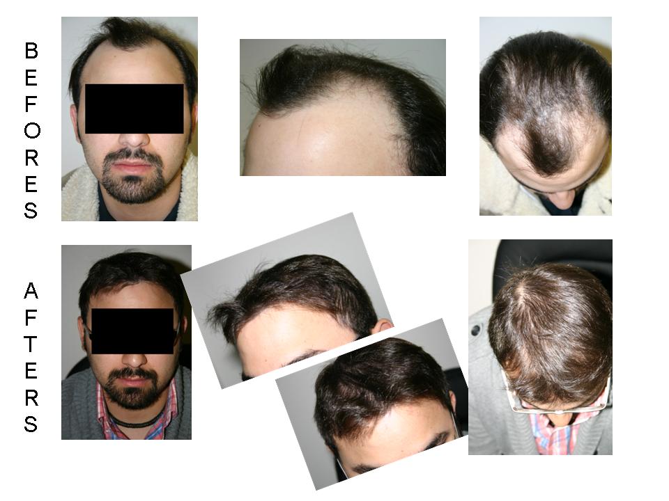 Limmer Hair Transplant