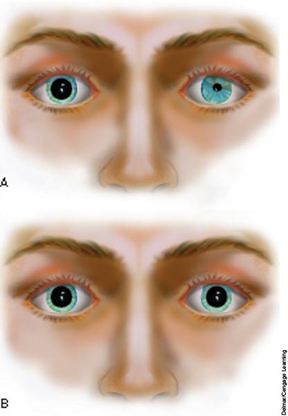 Al andar se hace el camino: FIXED AND DILATED PUPILS