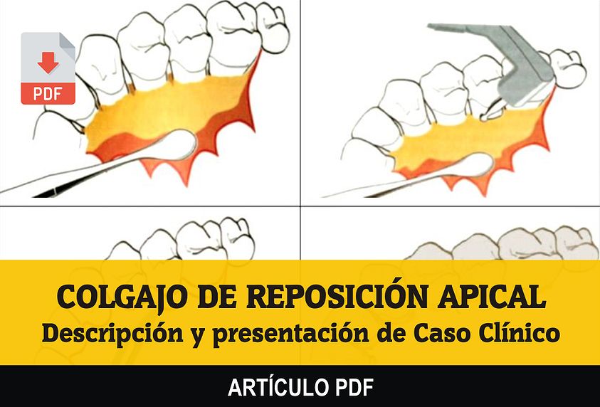 PDF: Colgajo de reposición apical de Nabers