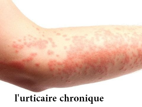 Remède pour l'urticaire chronique ~ Nos Conseils de Vie