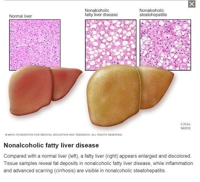 Chronically Interrupted...: Non-Alcoholic Fatty Liver Disease (NAFLD)