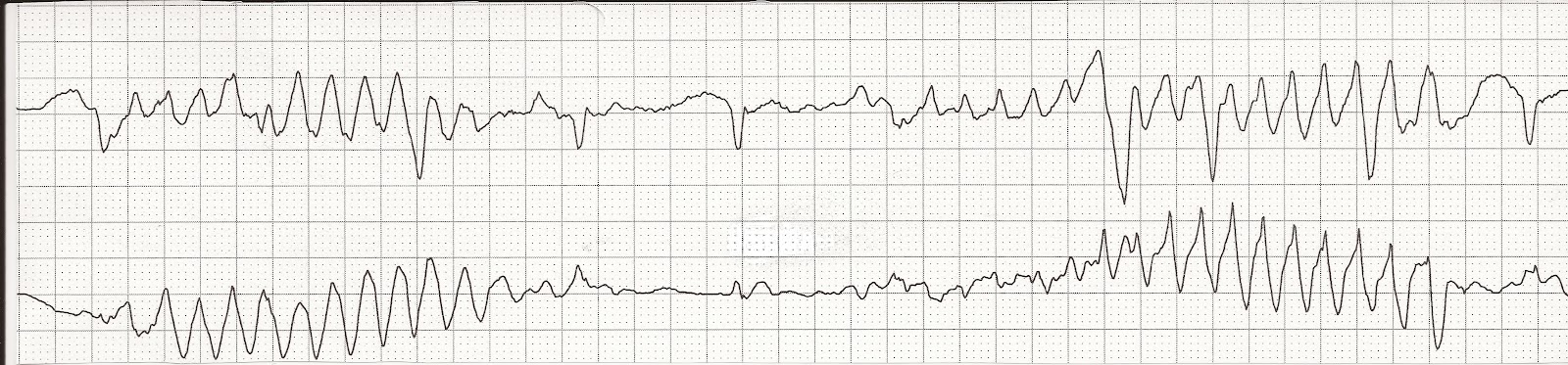Float Nurse: ACLS review: Wide Complex Tachycardia (WCT) Part 8