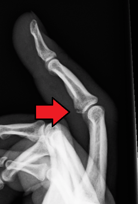 Avulsion Fracture Treatment | Avulsion Bone Fracture Surgery