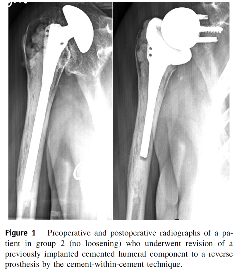 Shoulder Arthritis/Joint Replacement Rotator cuff tears: Revision ...