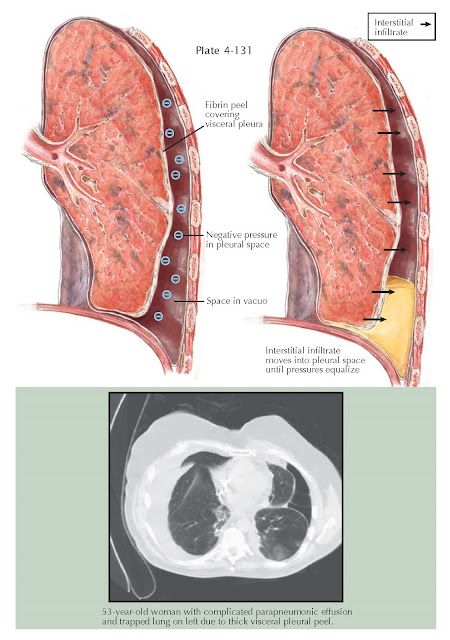 UNEXPANDABLE LUNG - pediagenosis