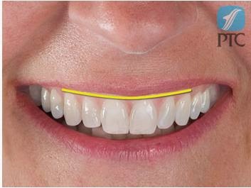 Omni Dental Group: Smile (Lip) Line