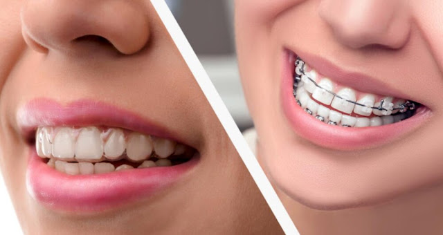Benefits Of Using Invisalign On Teeth