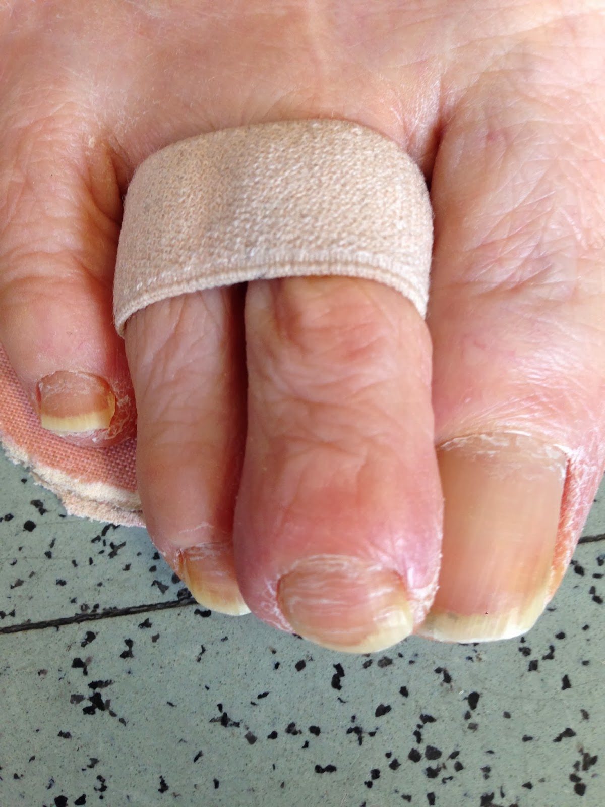 Foot and Ankle Problems By Dr. Richard Blake: Thursday's Orthotic ...