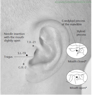 Acupuncture: SI - 19 (SMALL INTESTINE - 19)