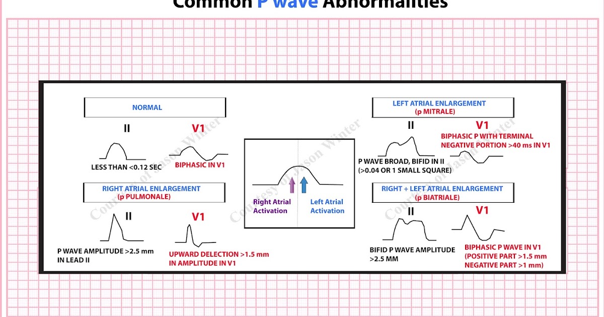 ECG Educator Blog : P wave Abnormalities