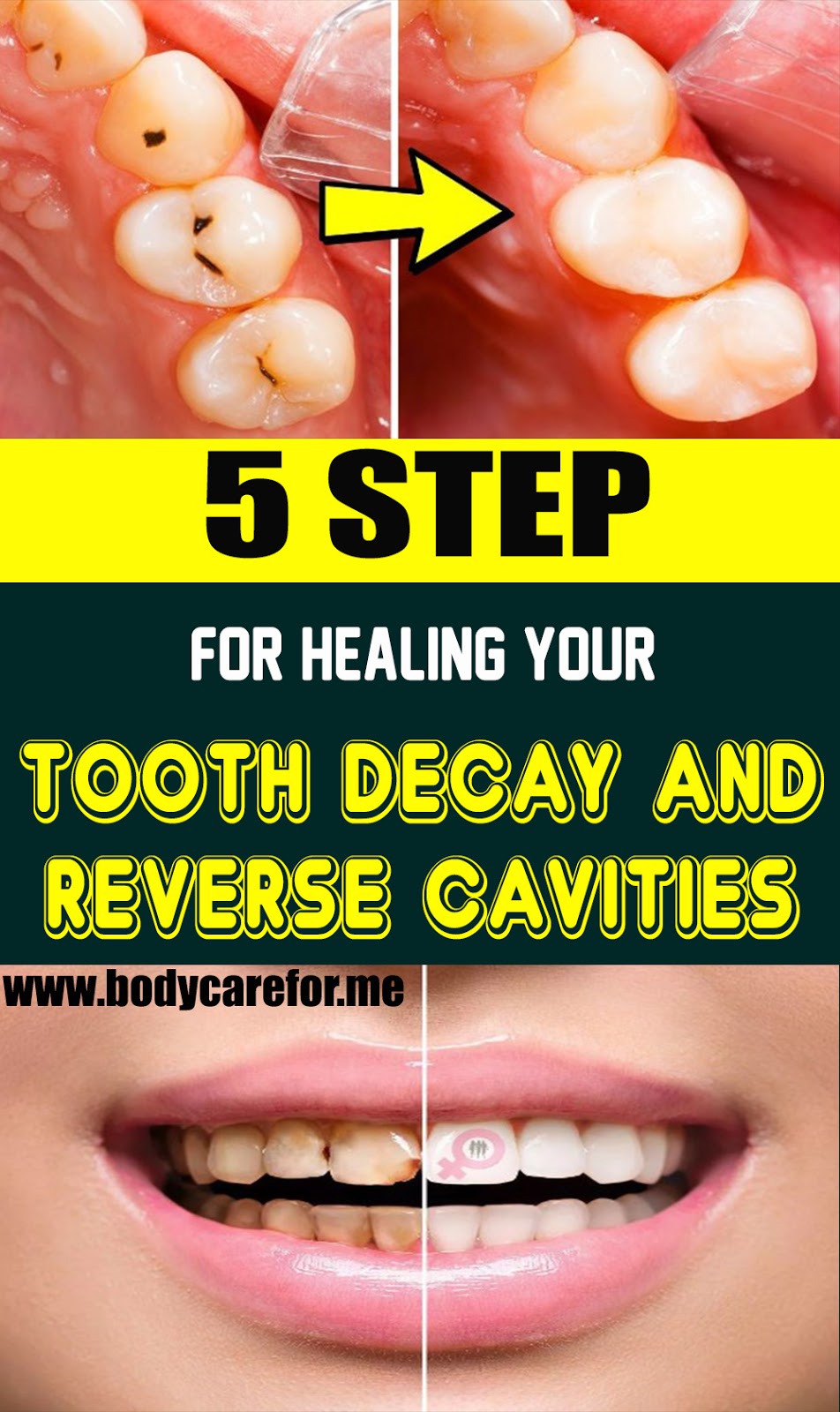 5 Steps For Healing Your Tooth Decay and Reverse Cavities