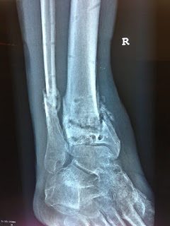 Paul Bours: #Paul #Bours - Surgical risk and complications