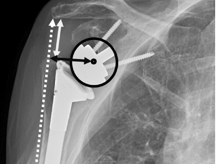 UW Shoulder and Elbow Academy: Reverse total shoulder - what factors ...