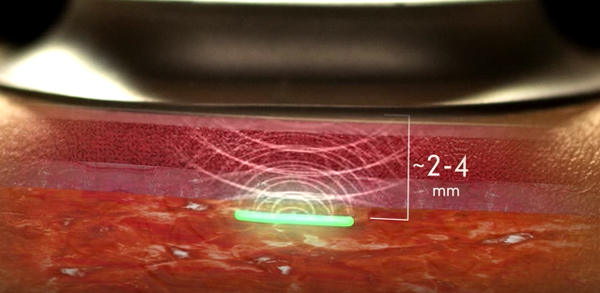 DARPA Invests $7.5 Million for Implantable Biosensor that are 3 ... DARPA Invests $7.5 Million for Implantable Biosensor that are 3 ...