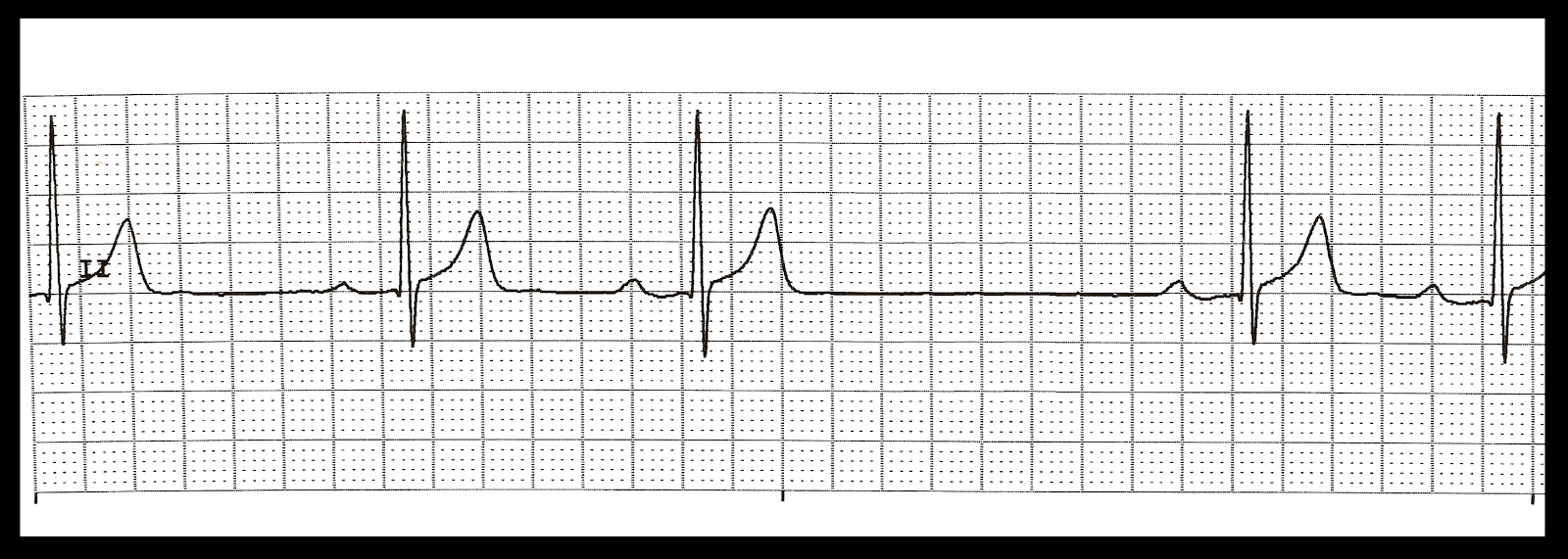 Various Sinus Arrests and Sinus Pauses