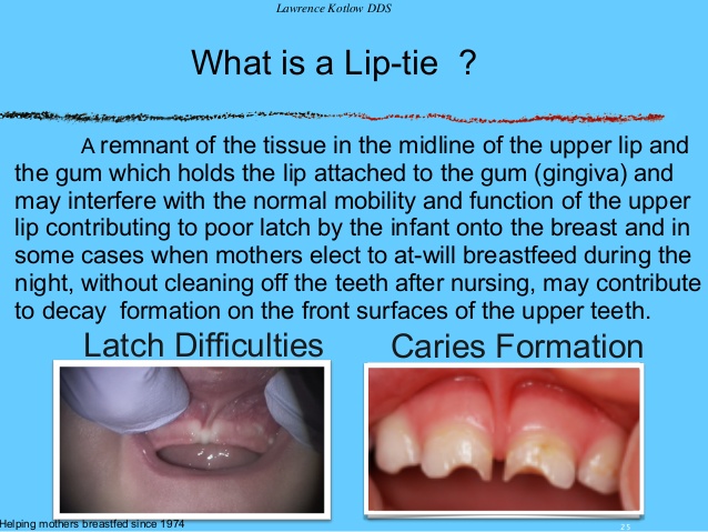 Dentist East Berlin PA: What is a Lip-tie?