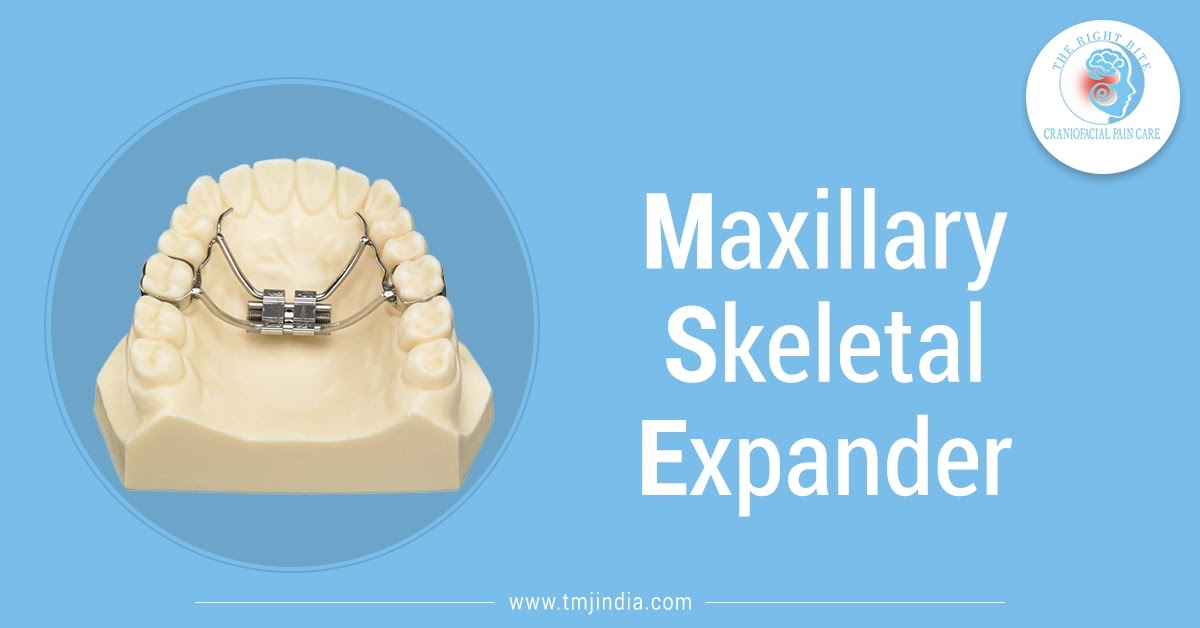 Treatment For TMJ Disorders: Maxillary Skeletal Expander