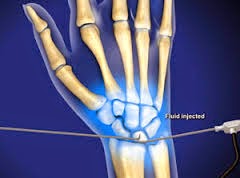 Medical Treatment Pictures-for Better Understanding: Arthroscopic Thumb ...