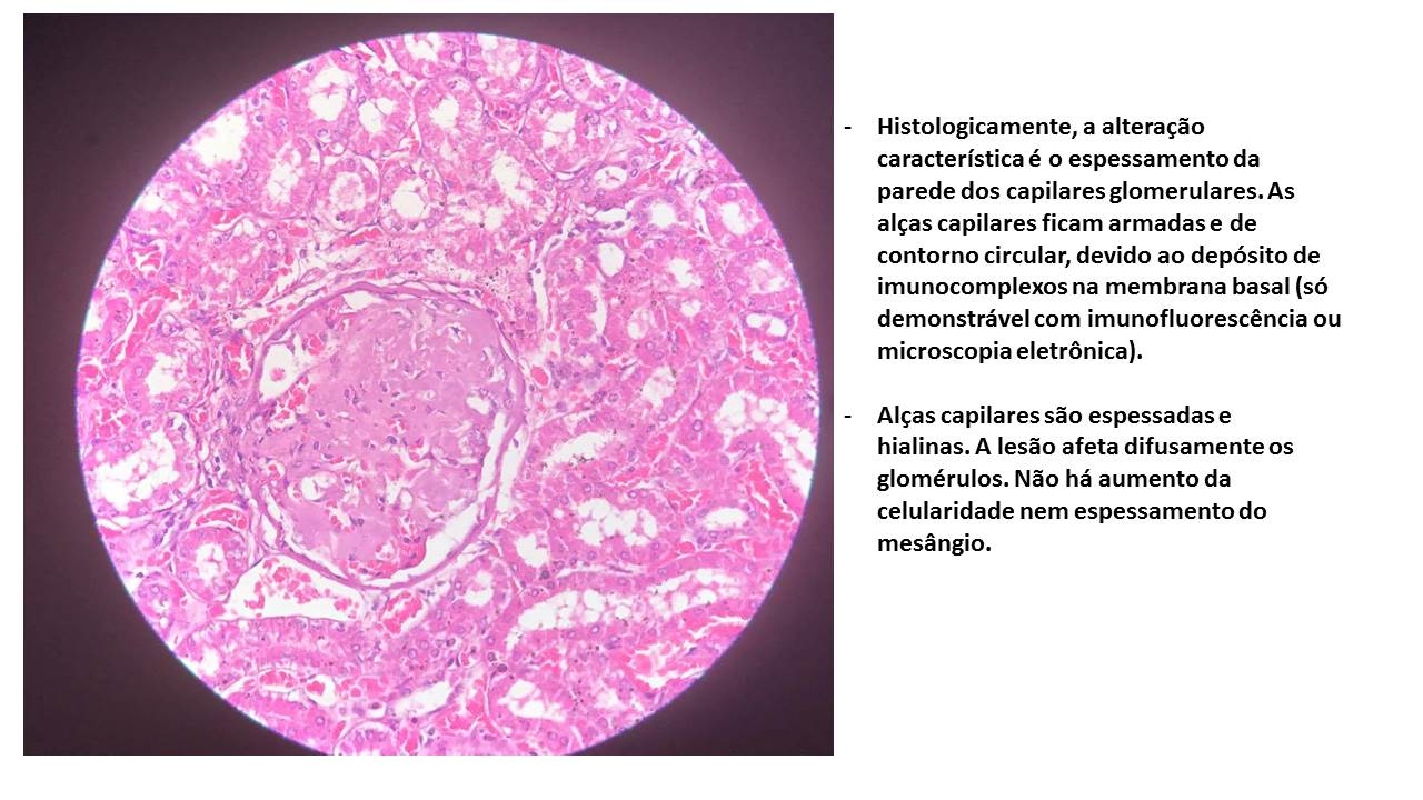 HISTOLOGIA90: RIM NORMAL E GLOMERULONEFRITES