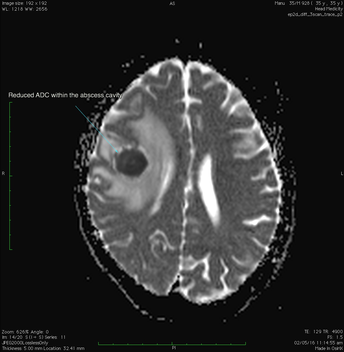 Ultimate Radiology : Frontal lobe abscess : follow up MRI