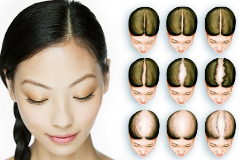 Rambutmu Rontok? Coba Gunakan 9 Bahan Ini untuk Menanggulanginya ...