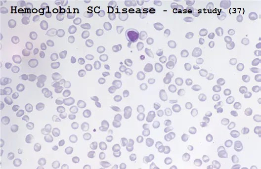 Case study (37) – Hemoglobin SC Disease