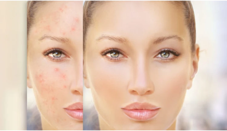 How to Remove Scars From Skin - World Informs