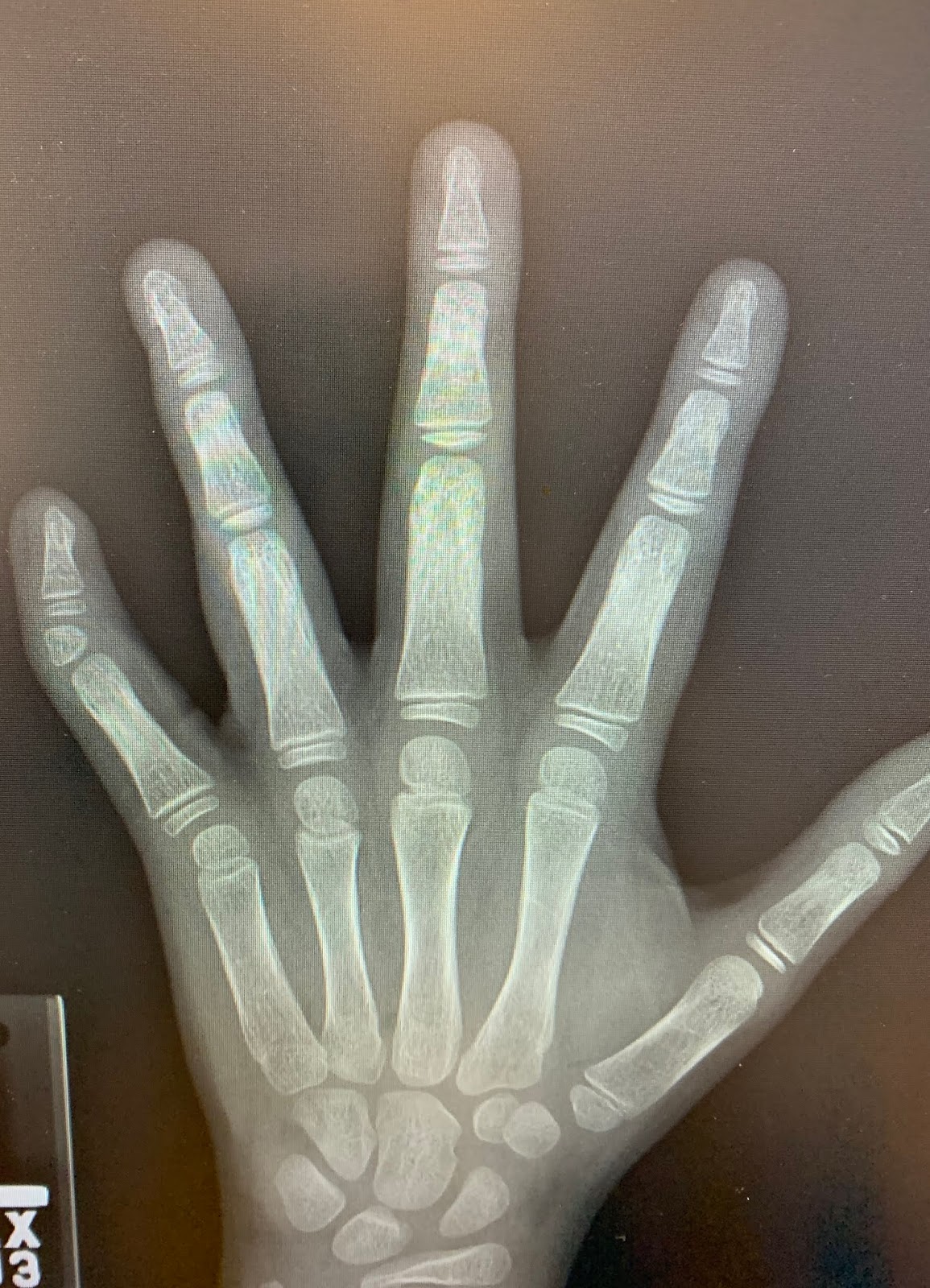 Recurrent Syndactyly | Congenital Hand and Arm Differences | Washington ...