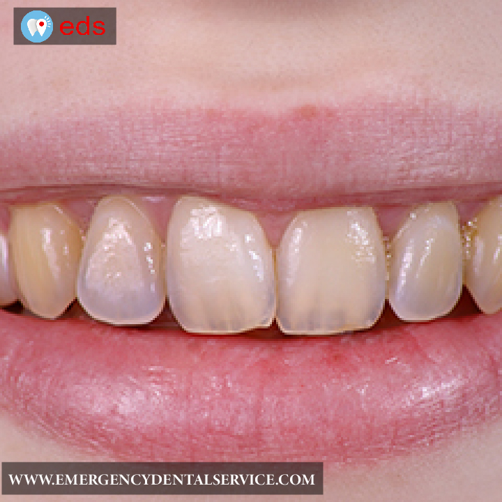 What is Tooth Erosion? And Why Should You Care?