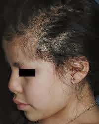 Medical Treatment Pictures-for Better Understanding: Conradi-Hunermann ...