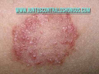 Juntos Contra Los Hongos Blog: Hongos en la Piel Sintomas – Tipos de ...