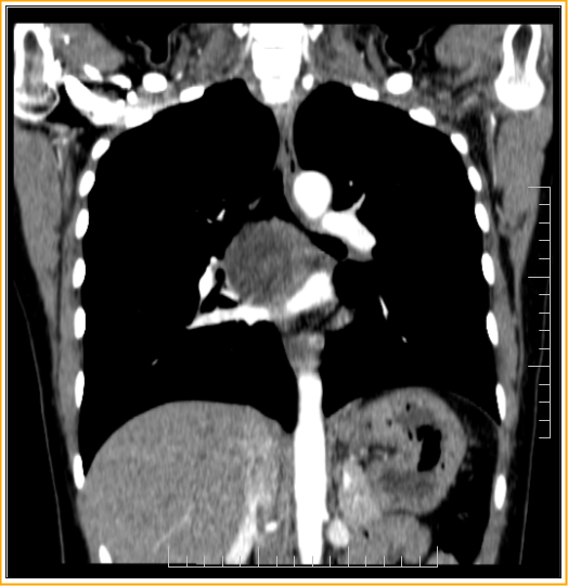 Bronchogenic Cyst-CT - Sumer's Radiology Blog