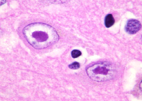 neuropathology blog: Cowdry A intranuclear inclusions in a case of ...