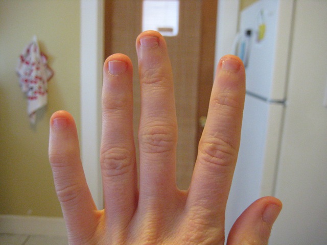 Eating Disorder Blog - Overtaking Edith: Biting my Nails